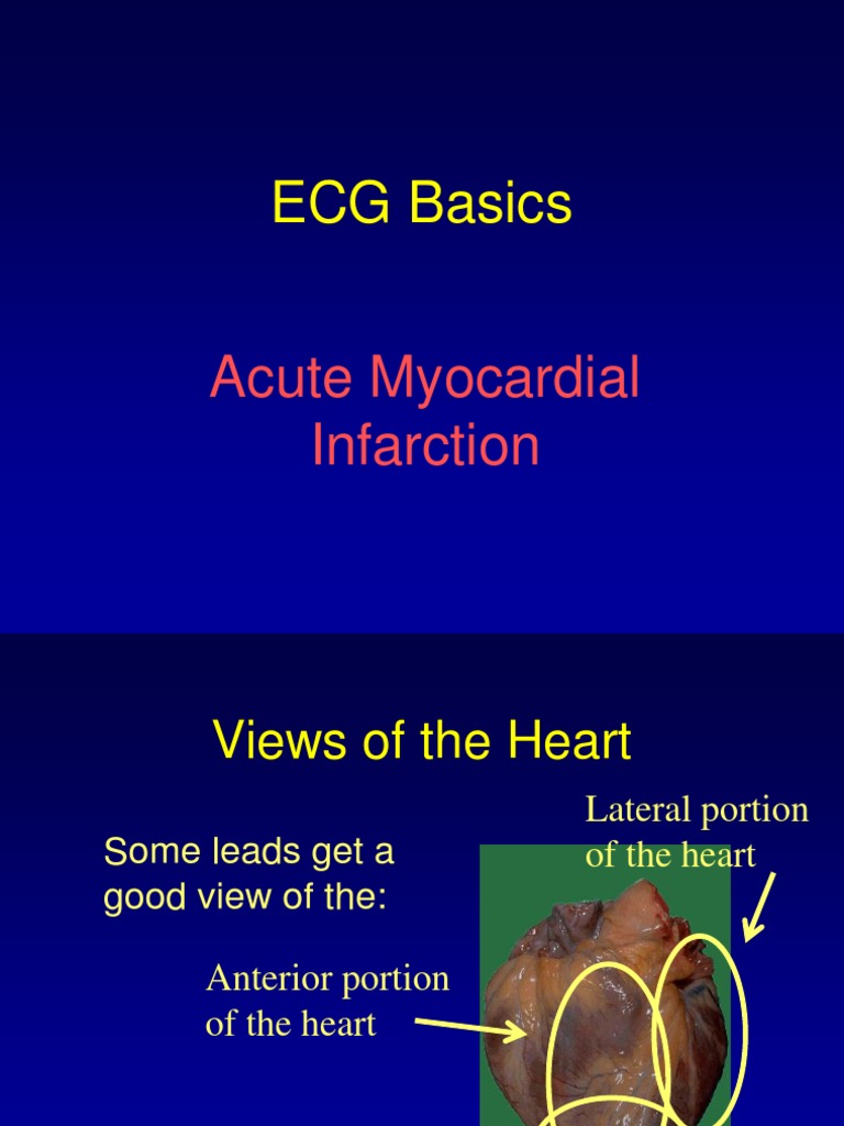 ECG Basics: Acute Myocardial Infarction | PDF | Electrocardiography | Ischemia