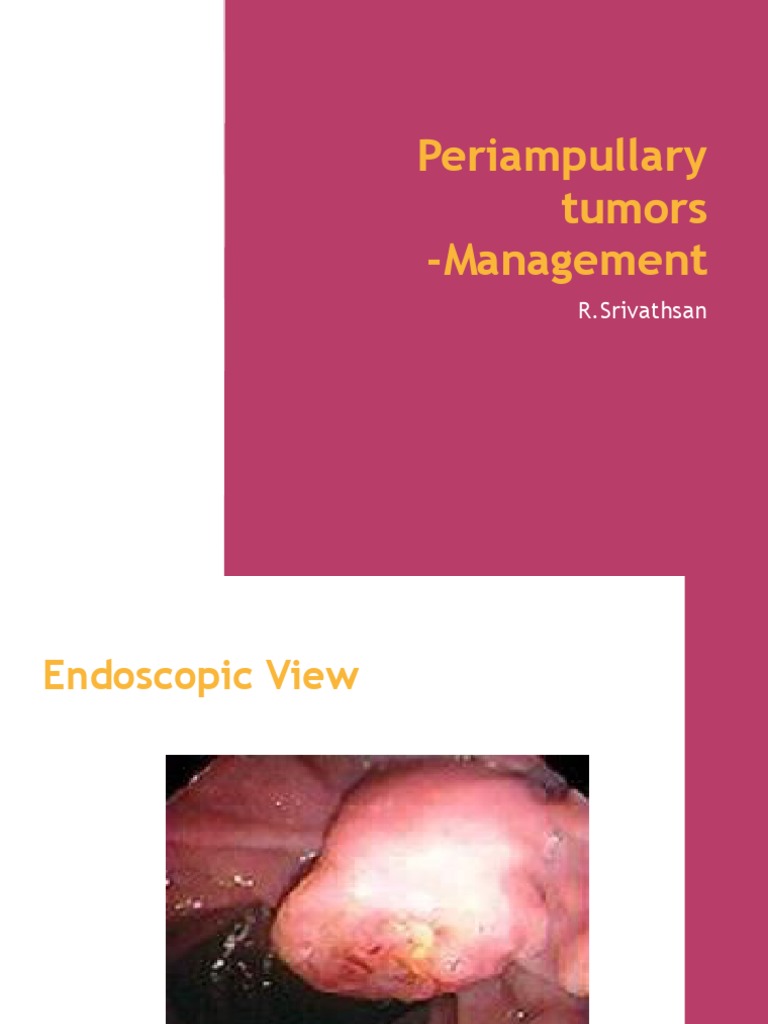 Periampullary Carcinoma | Pancreatic Cancer | Pancreas