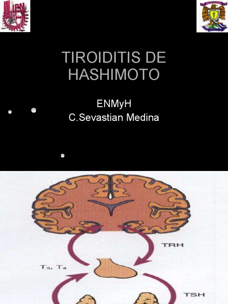 Tiroiditis de Hashimoto | PDF