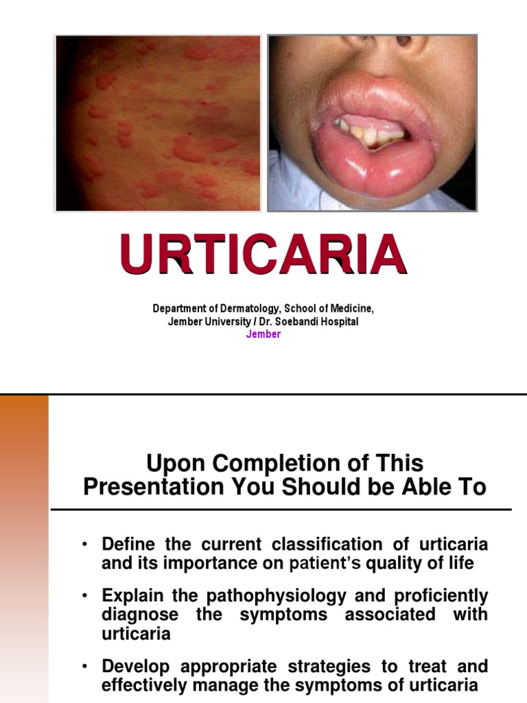 Urticaria | PDF | Clinical Medicine | Immunology