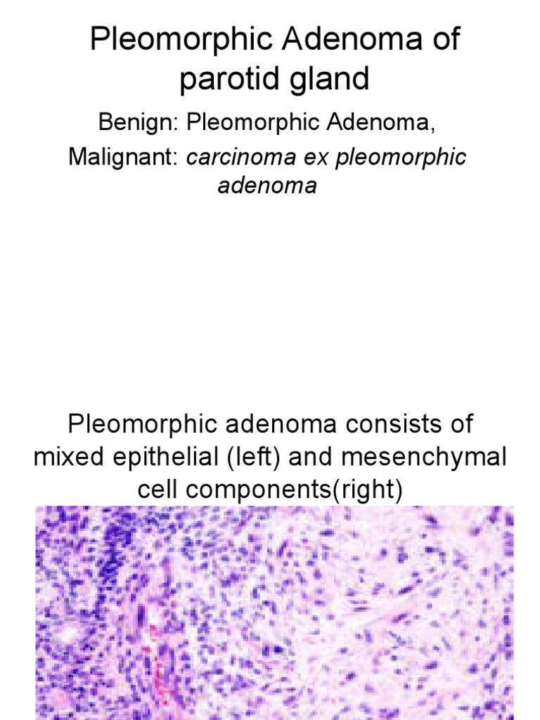 Pleomorphic Adenoma of Parotid Gland | Adenoma | Epithelium