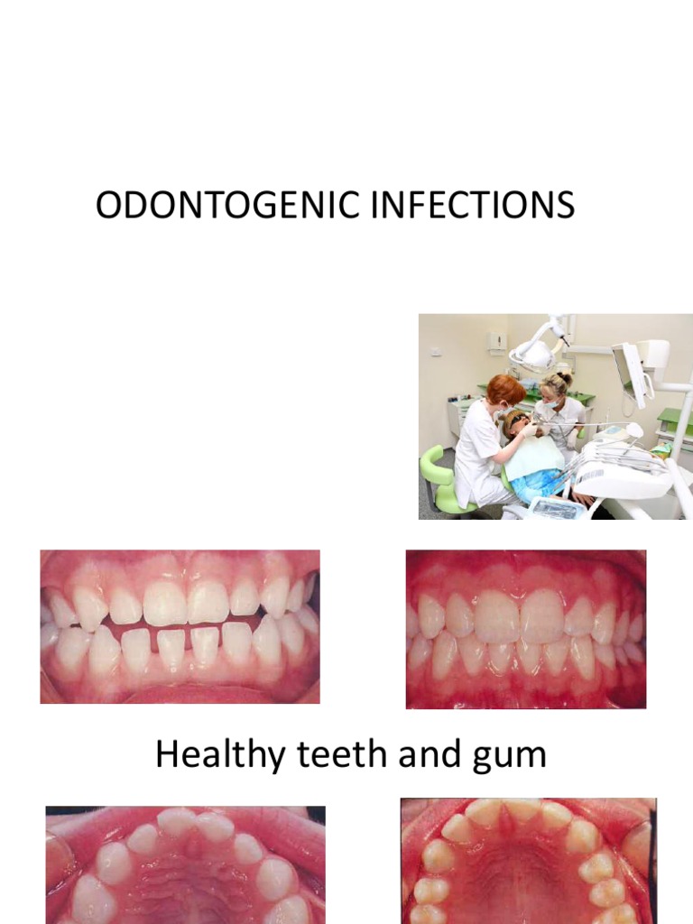 Odontogenic Infections | PDF | Mouth | Dentistry