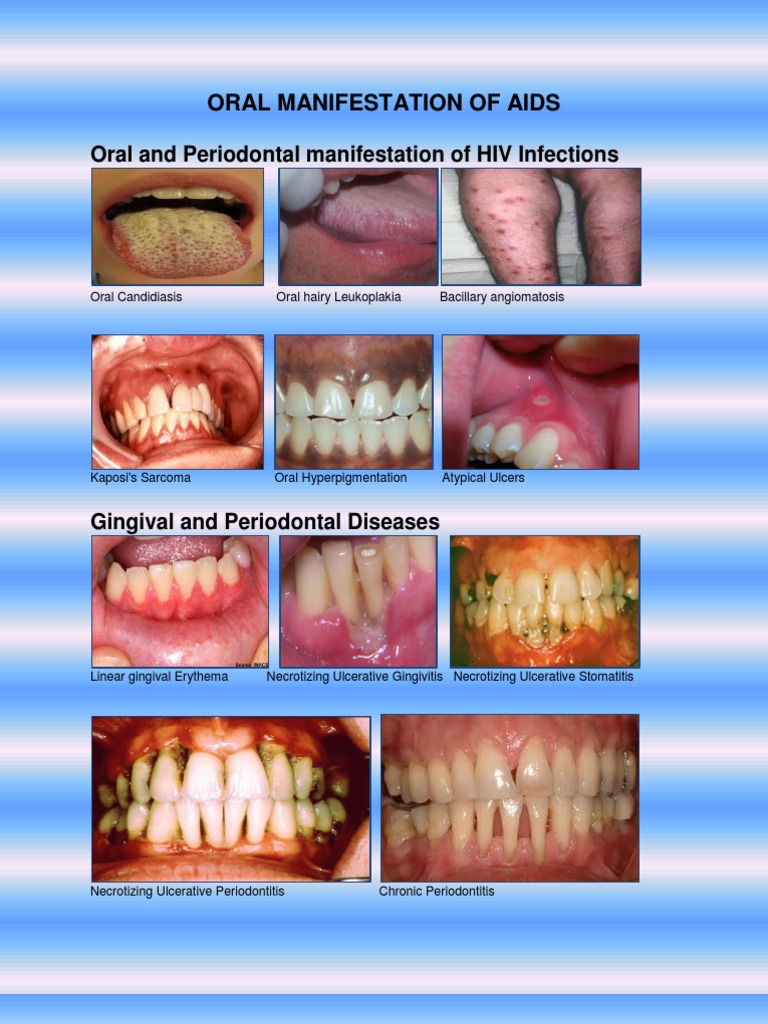 Oral and Periodontal Manifestation of HIV Infections | PDF | Science ...