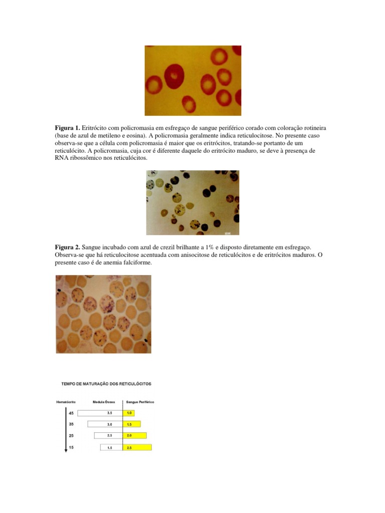 Reticulocitos.pdf | Anemia | Hemácia