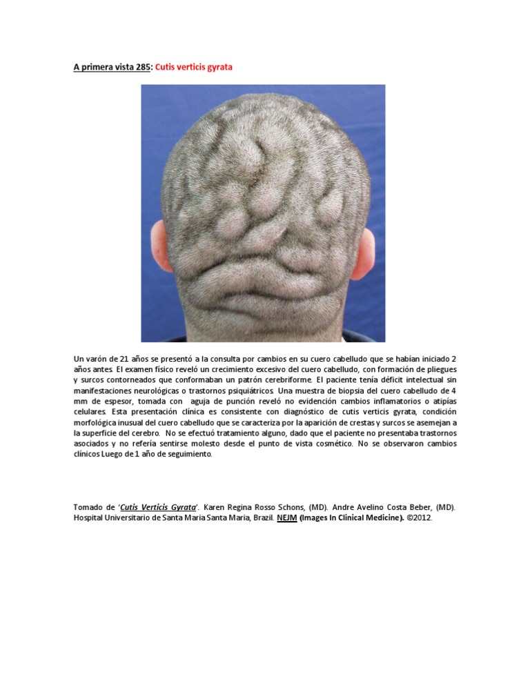 A Primera Vista 285 (Cutis Verticis Gyrata) | PDF | Autosuperación