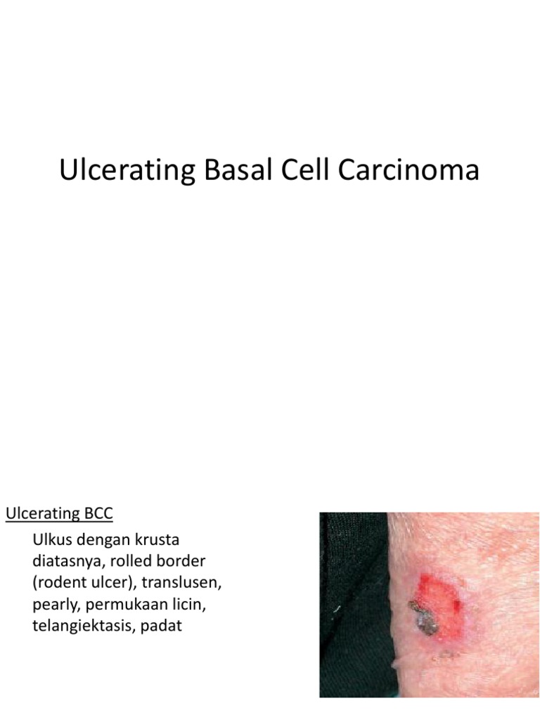 Ulcerating Basal Cell Carcinoma | PDF