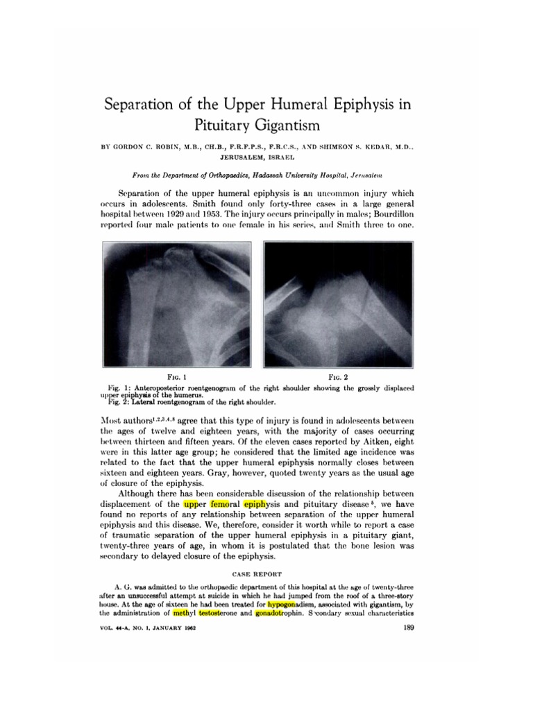 Separation of The Upper Humeral Epiphysis in Pituitary Gigantism | PDF ...