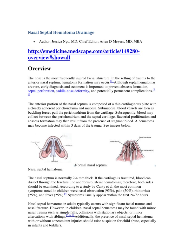 Nasal Septal Hematoma Drainage | Human Nose | Implant (Medicine)