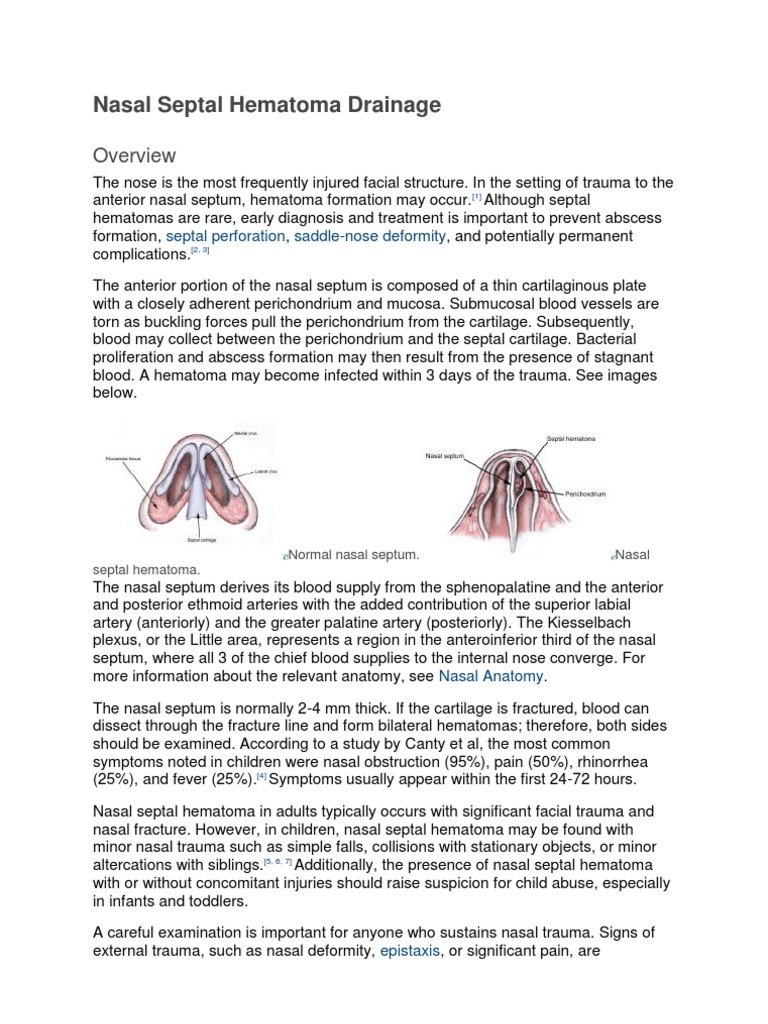 Nasal Septal Hematoma Drainage | PDF | Human Nose | Major Trauma