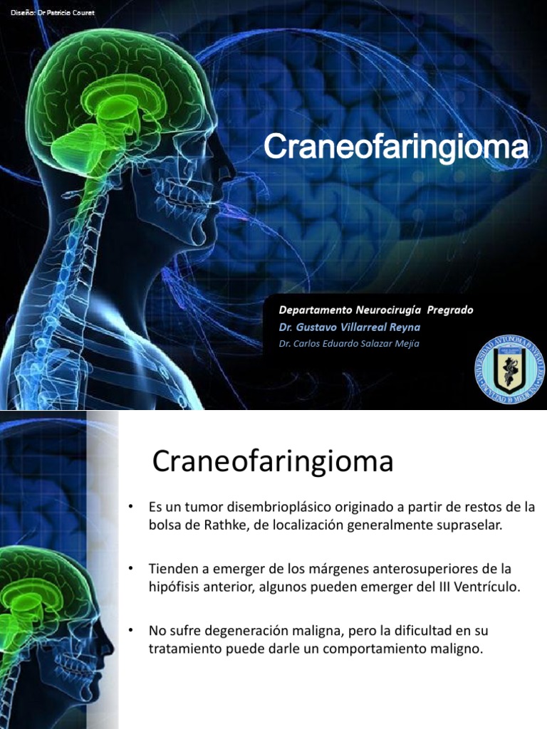 Craneofaringioma: Tipos y Tratamiento | PDF | Especialidades Medicas ...