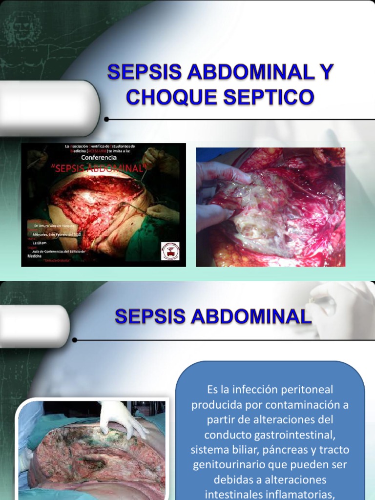 Presentacion Sespsis Abdominal y Choque Septico | Septicemia | Inflamación