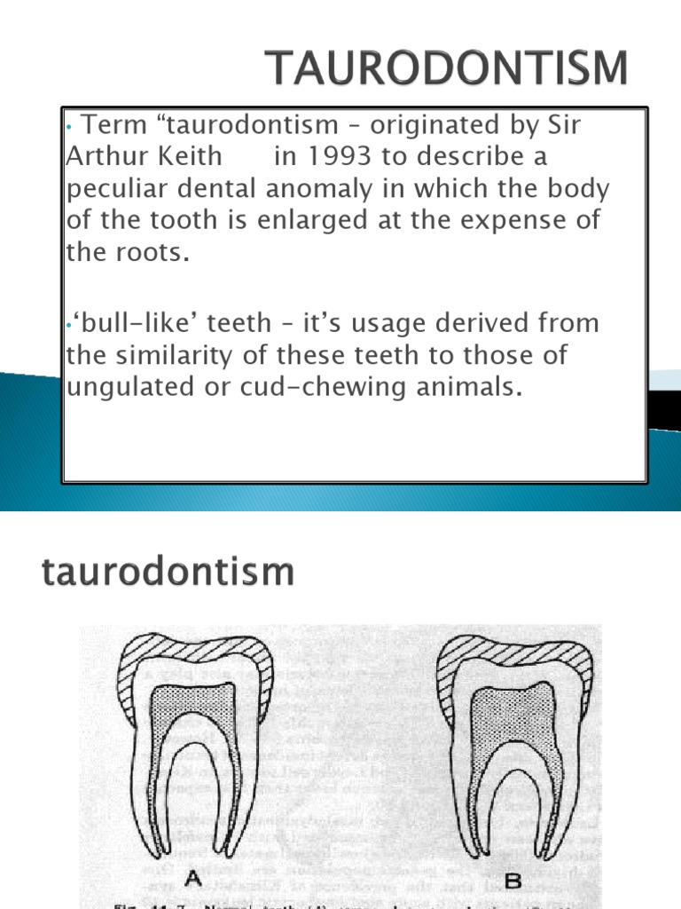 TAURODONTISM | PDF | Mouth | Dentistry