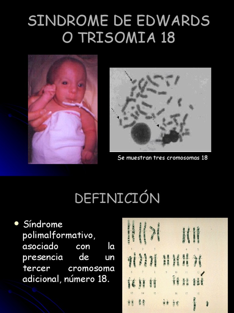 Sindrome de Edwards o Trisomia 18 | PDF | Nucleo celular | Biología