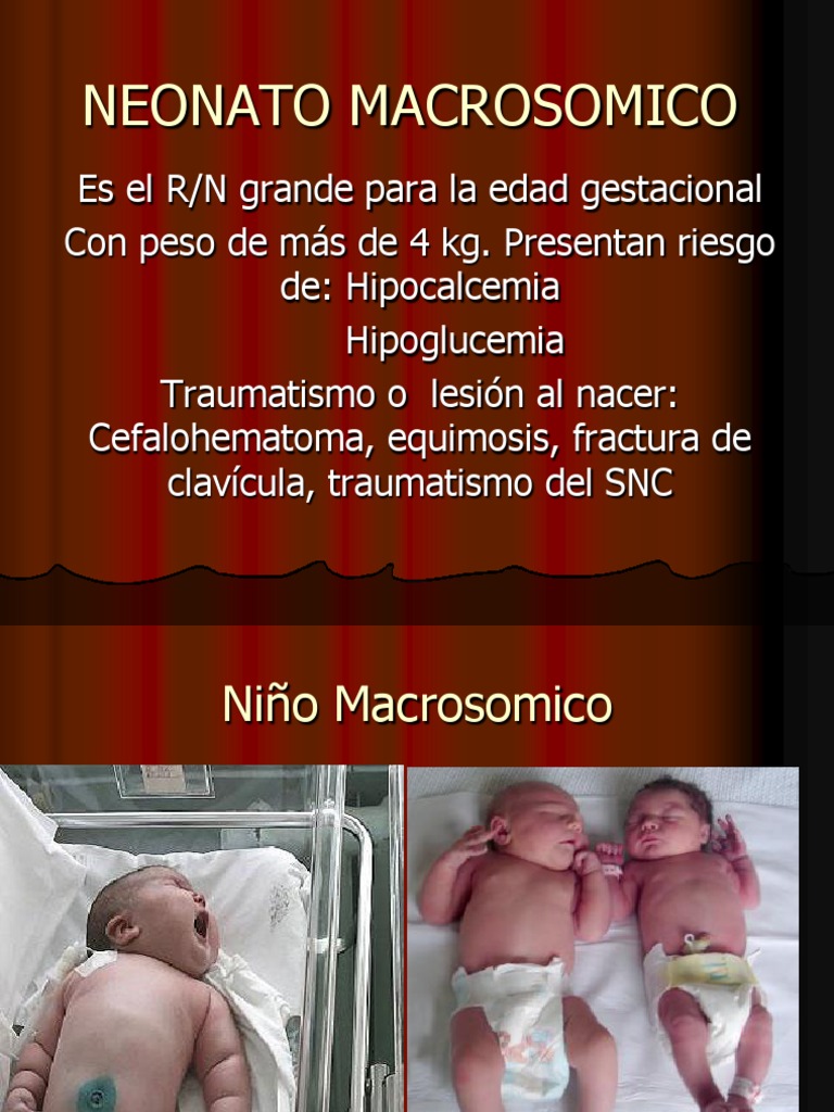 Neonato Macrosomico | PDF