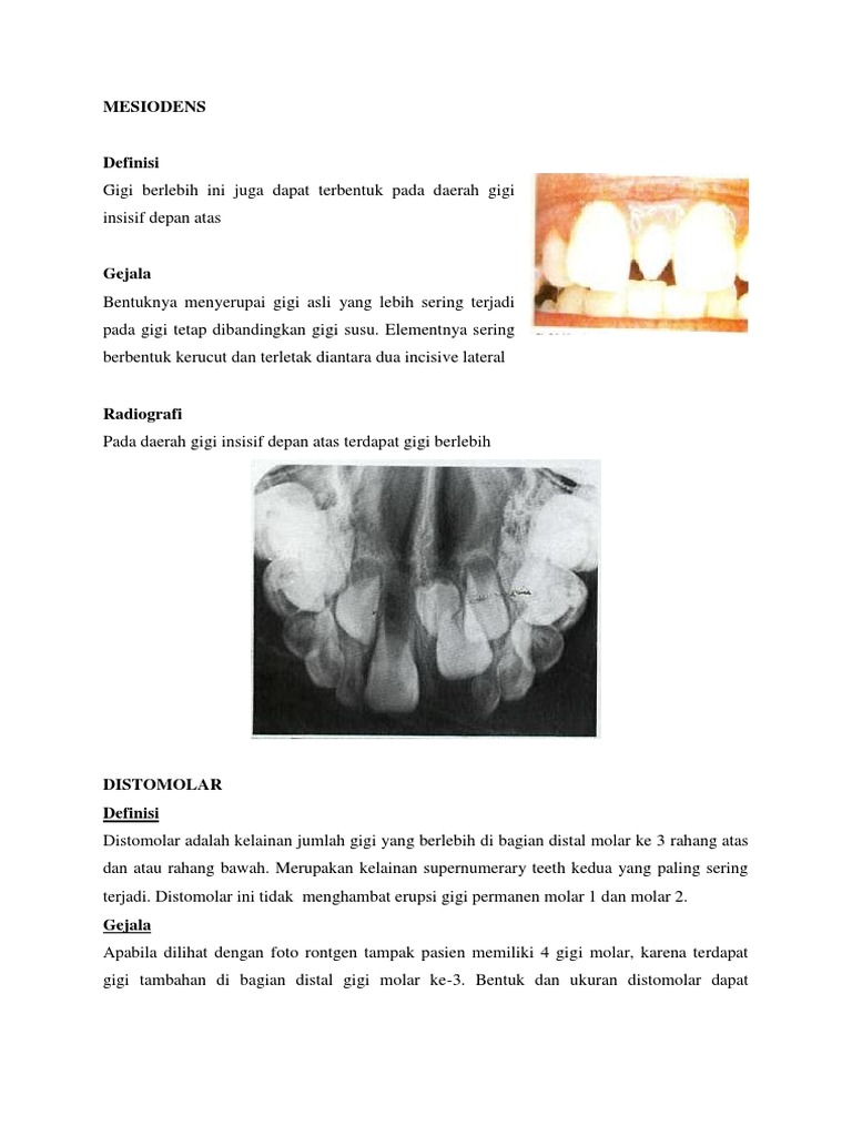 Mesiodens, Distomolar, Paramolar | PDF