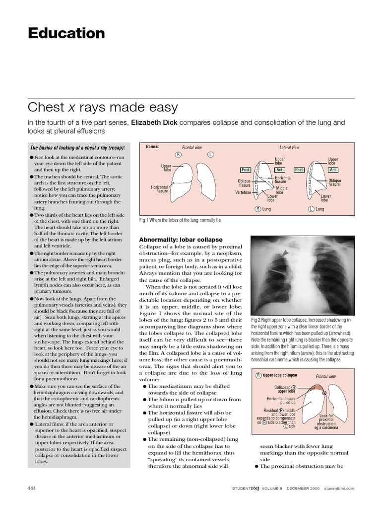 How To Read Chest X Ray | PDF | Lung | Thorax