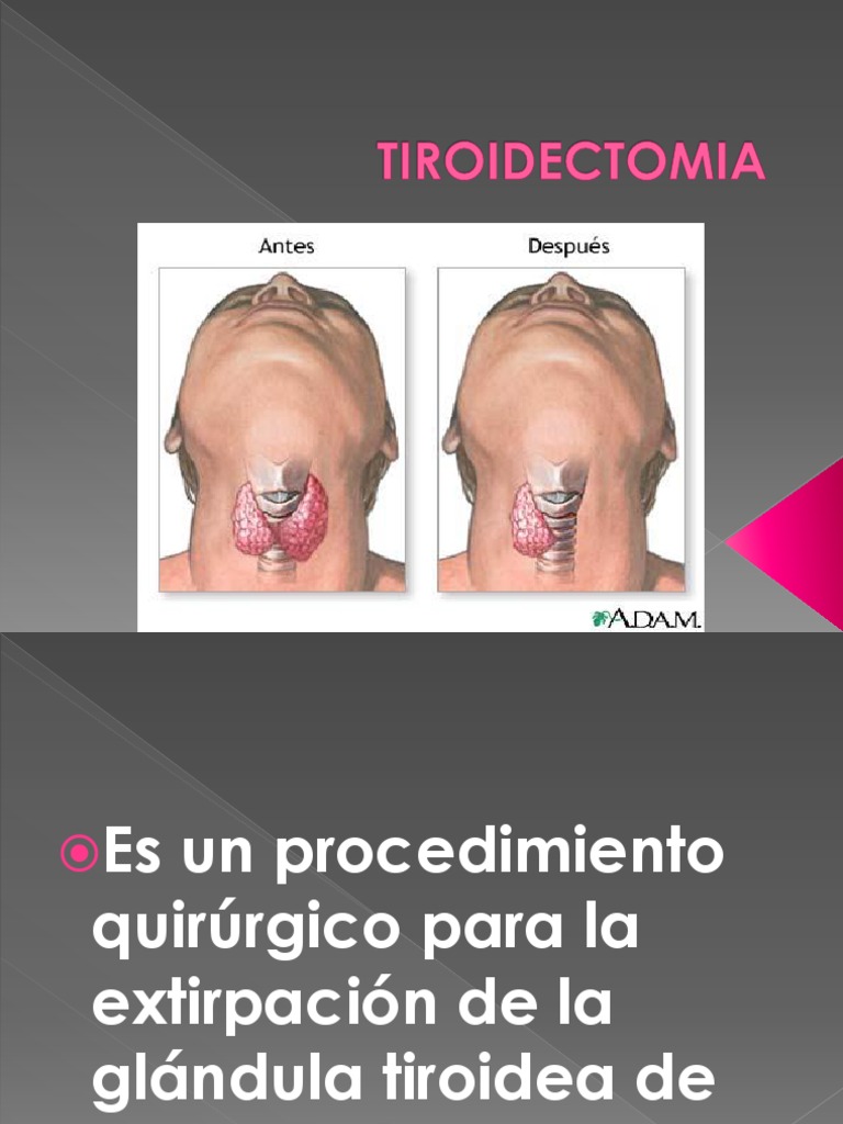 TIROIDECTOMIA | PDF | Tiroides | Cirugía