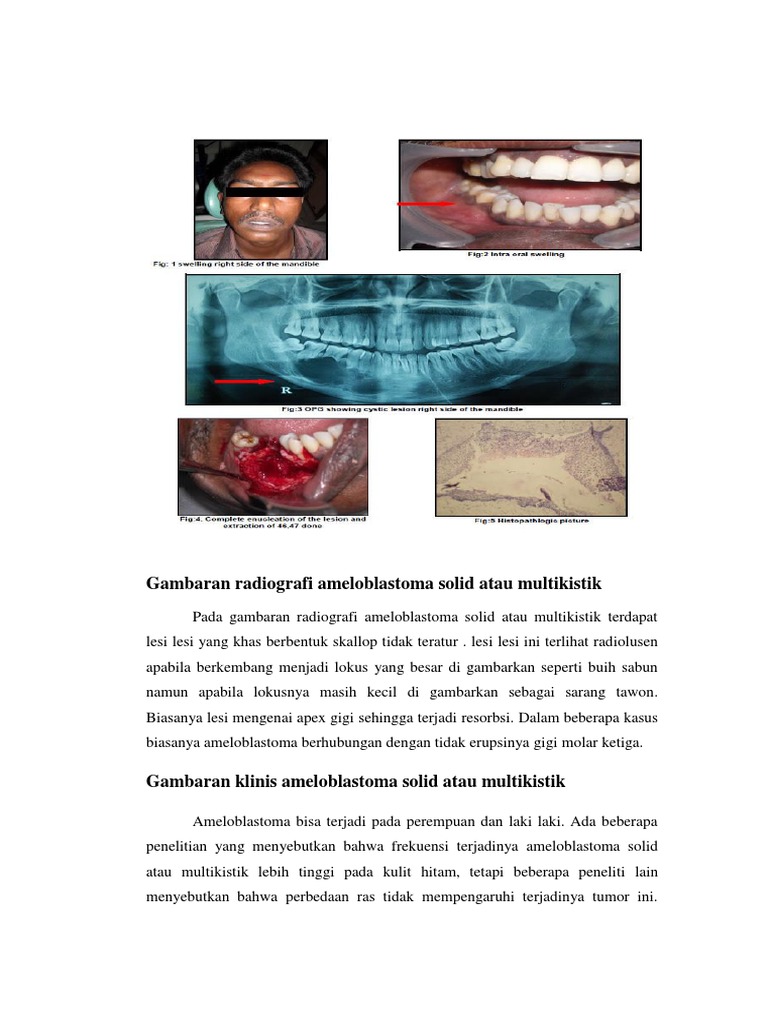 Gambaran Radiografi Ameloblastoma Solid Atau Multikistik | PDF ...