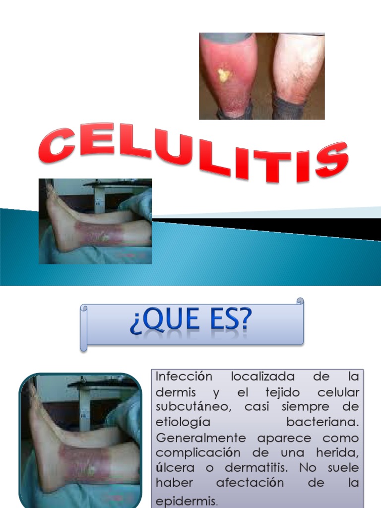 Celulitis | Piel | Medicina