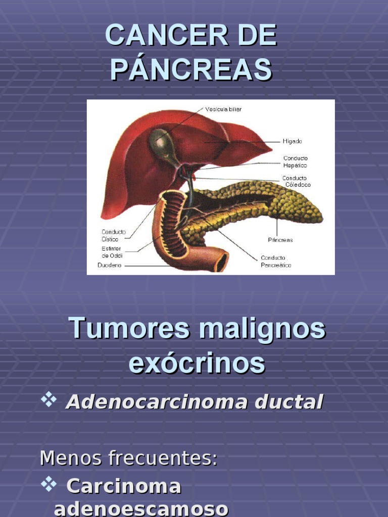 Cáncer de Páncreas: Diagnóstico y Tratamiento | PDF | Cáncer de ...