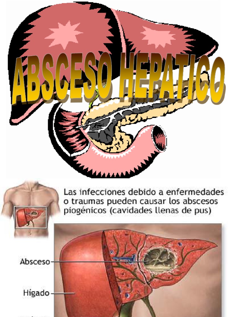 ABSCESO HEPATICO 1 | Microbiology | Medical Specialties