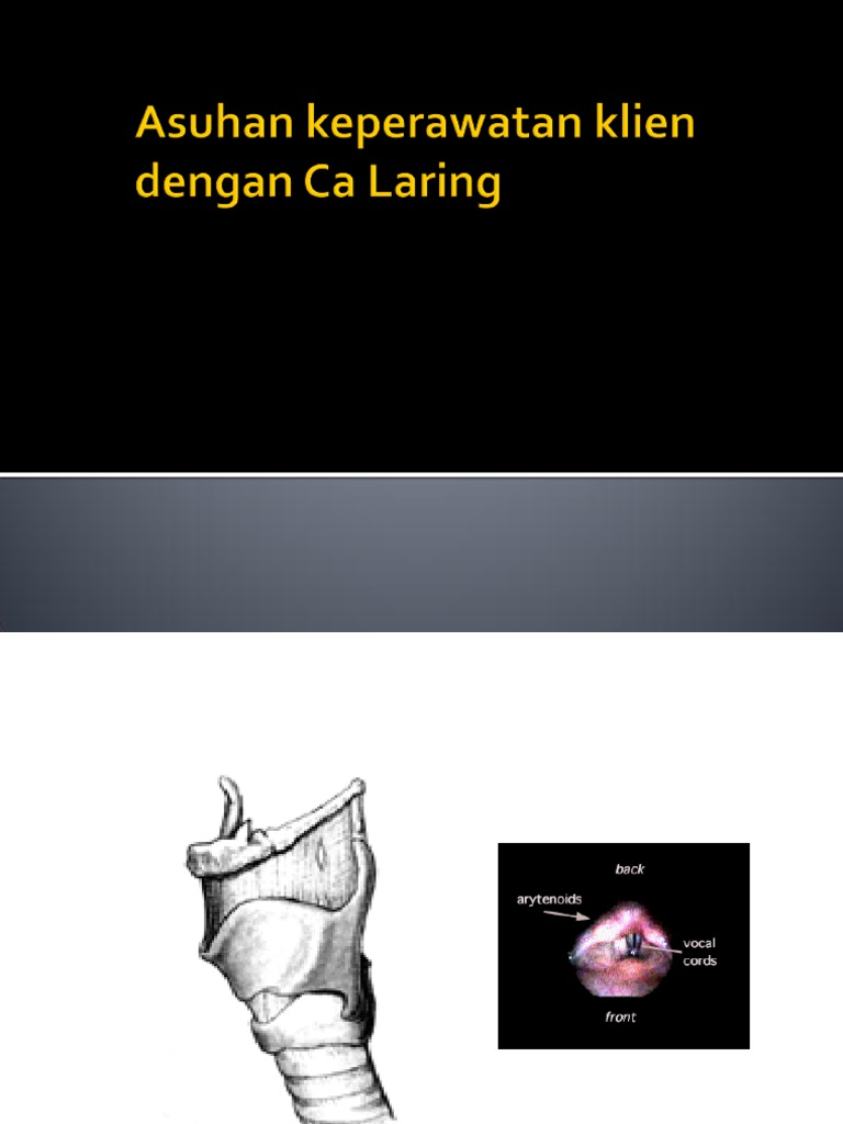 Askep CA Laring | PDF | Neoplasms | Medicine