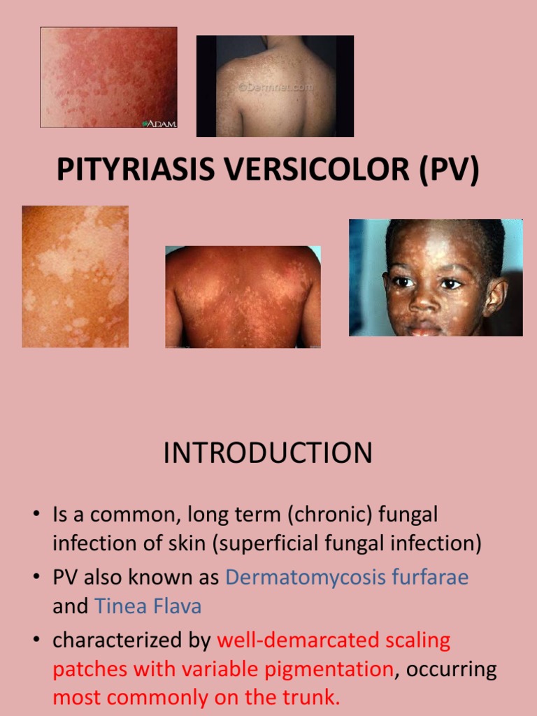 Pityriasis Versicolor Part 1 | PDF | Skin | Integumentary System