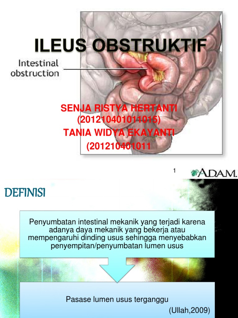 Ileus Obstruksi | PDF