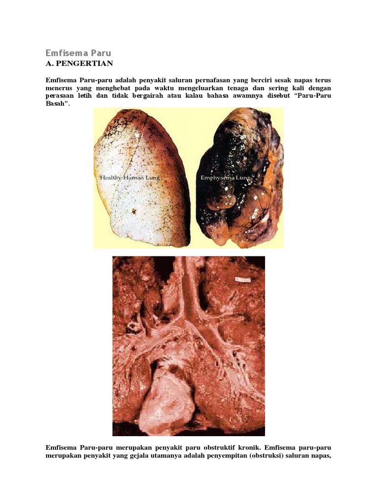 Emfisema Paru | PDF