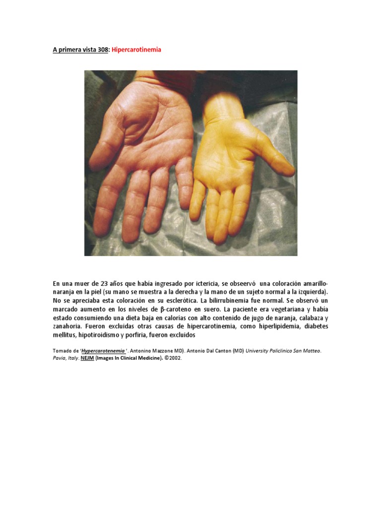 Hipercarotinemia: Causas y Síntomas | PDF | Relaciones personales ...