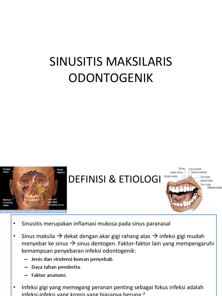 Sinusitis Maksilaris Odontogenik Upload | PDF