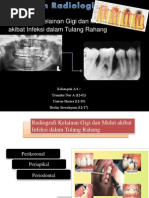 Bahaya Gangren Radix pada Gigi | PDF