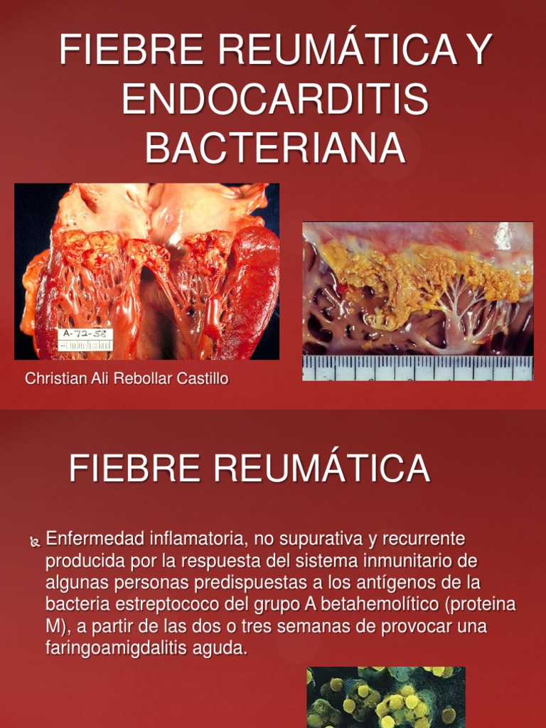 Fiebre Reumática y Endocarditis: Guía Clínica | PDF | Microbiología ...