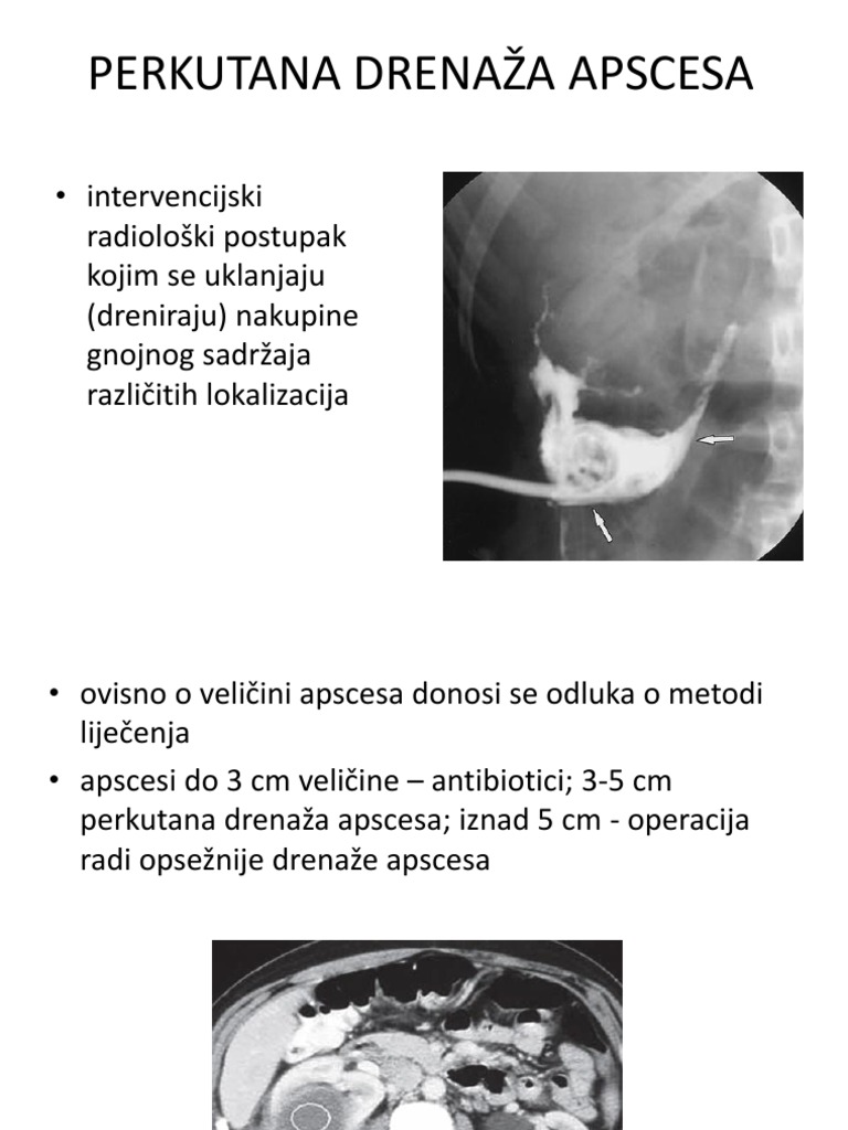 PERKUTANA DRENAŽA APSCESA, PERKUTANA BILIJARNA DRENAŽAa | PDF