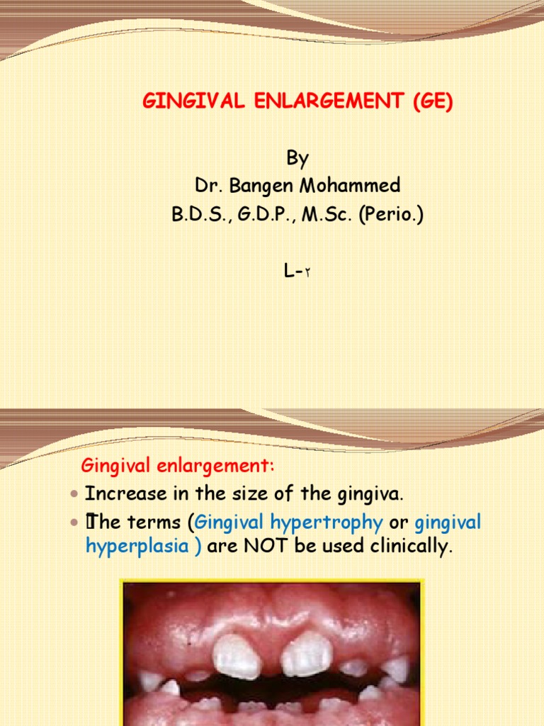 Classification and Etiology of Gingival Enlargement: A Comprehensive ...