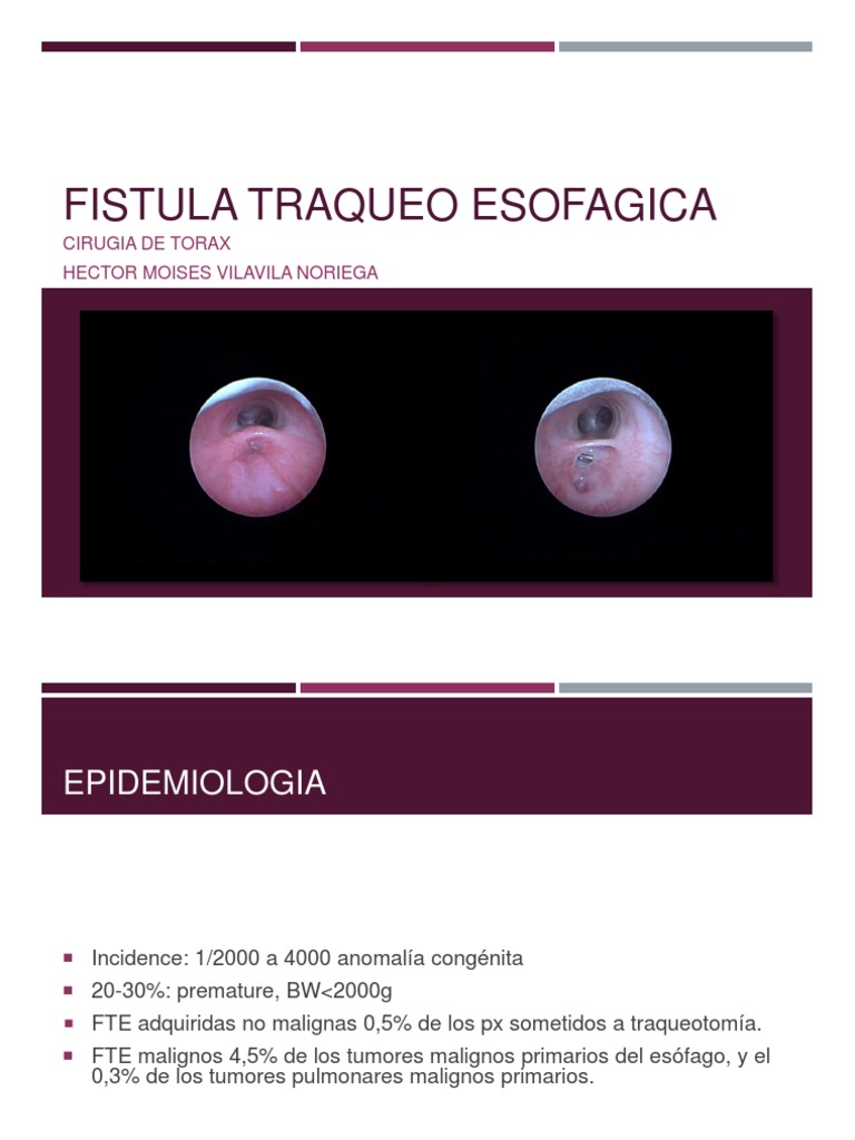 Fistula Traqueo Esofagica | PDF | Cáncer de esófago | Tos