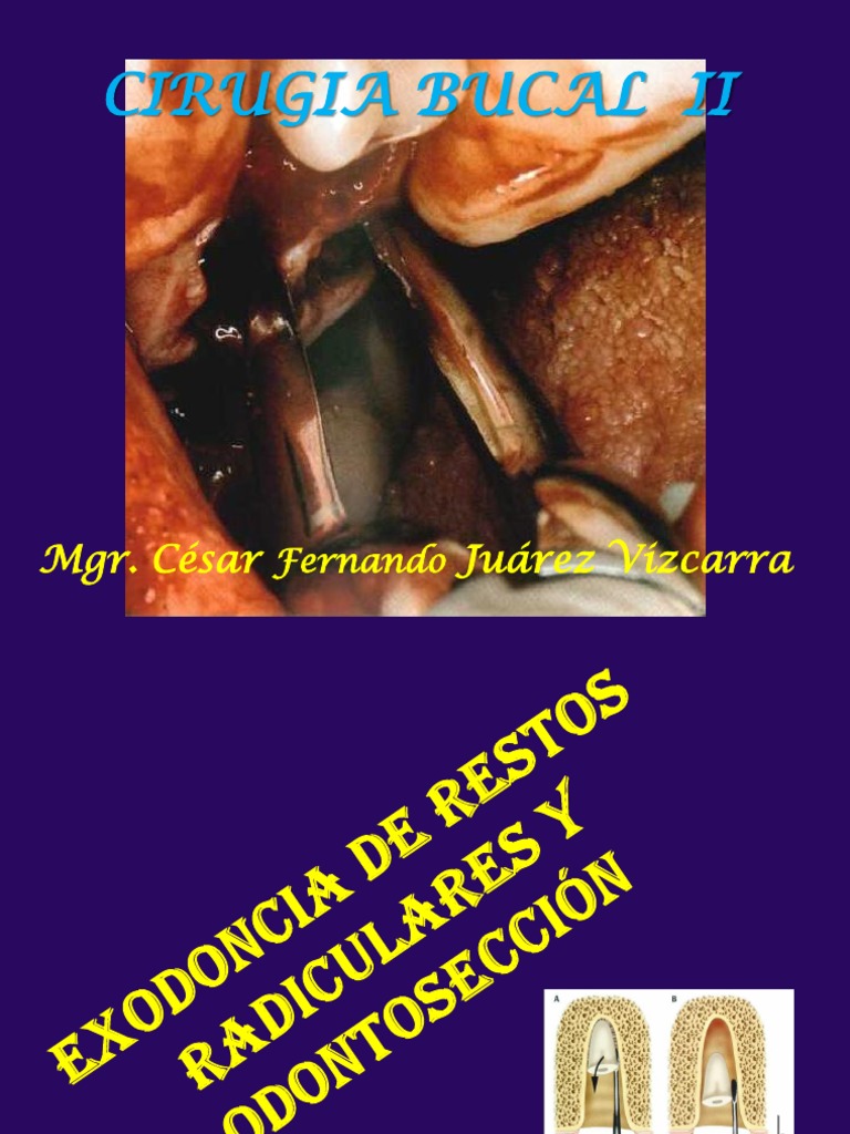 1 Exodoncia de Restos Radiculares Complejas y Odontosección | PDF ...
