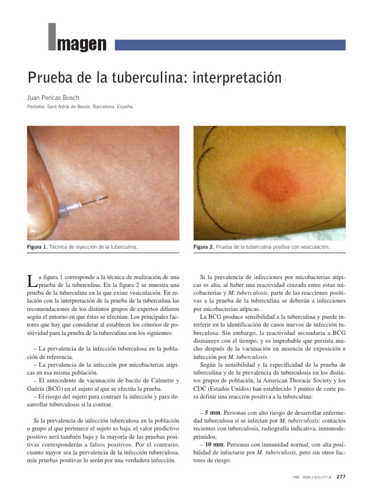 PPD | PDF | Tuberculosis | Medicina CLINICA