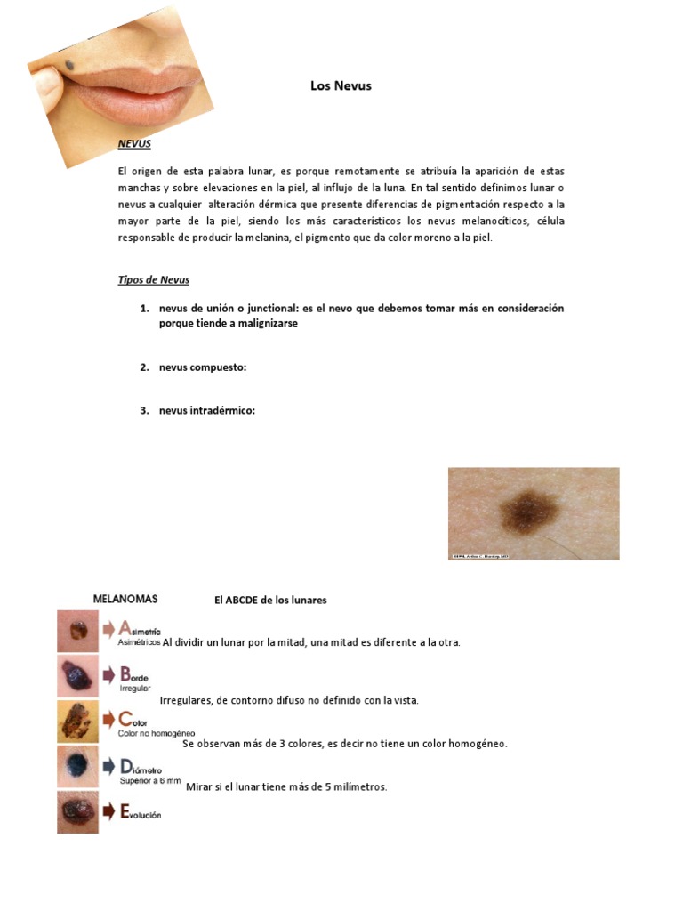 Los Nevus: Tipos, Factores de Riesgo y Medidas de Prevención | PDF ...