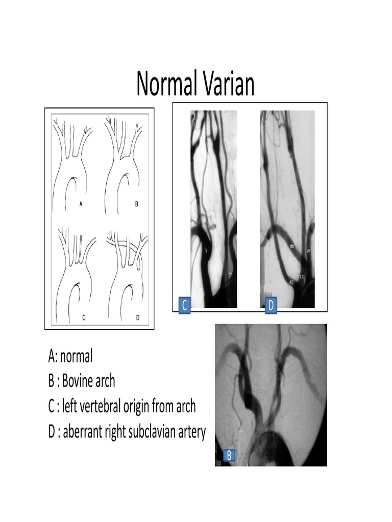 Carotid Artery Variants Explained | PDF