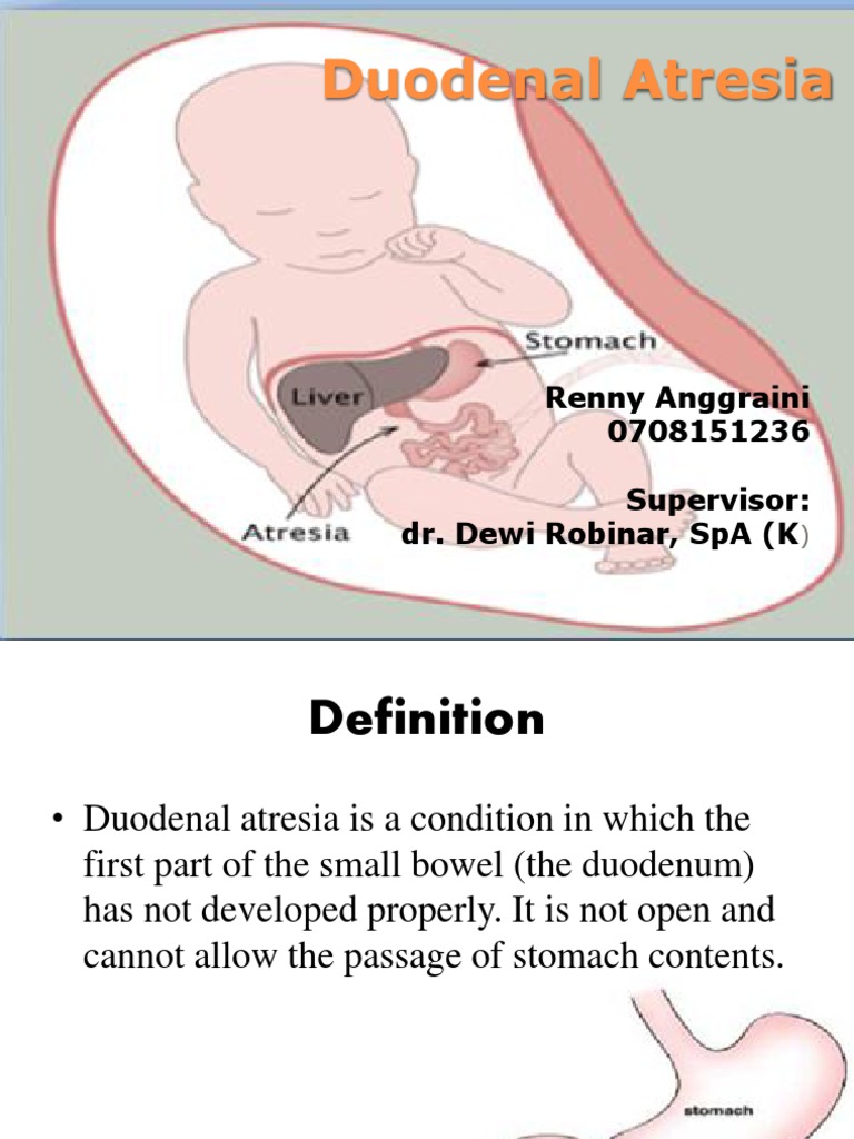 Duodenal Atresia | PDF | Congenital Disorder | Gastrointestinal Tract