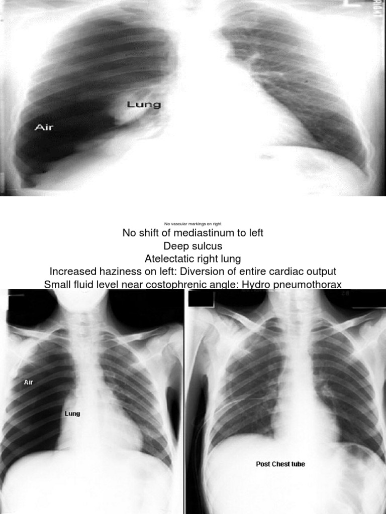 x-rays of chest | Lung | Respiratory System