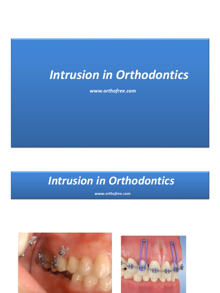 12-Intrusion in Orthodontics-http://orthofree.com/en/ | Face | Physiognomy
