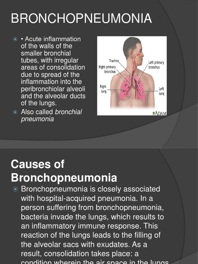 Bronchopneumonia | PDF | Pneumonia | Lung