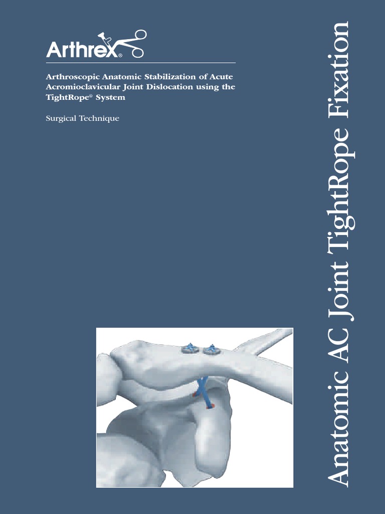Arthrex ACJ Reconstruction | PDF | Joints | Musculoskeletal System