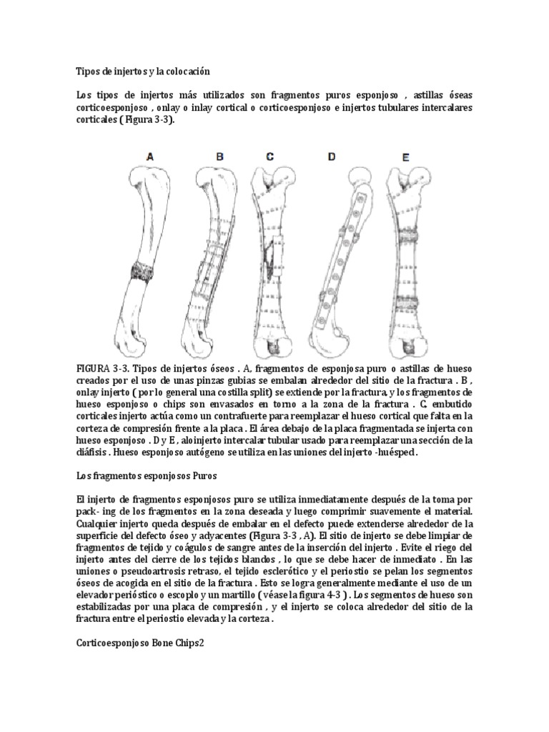 Tipos de injertos y la colocación | Hueso | Injerto