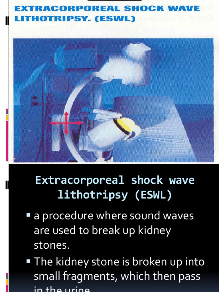 Eswl 1 | PDF | Urinary Tract Infection | Diseases And Disorders