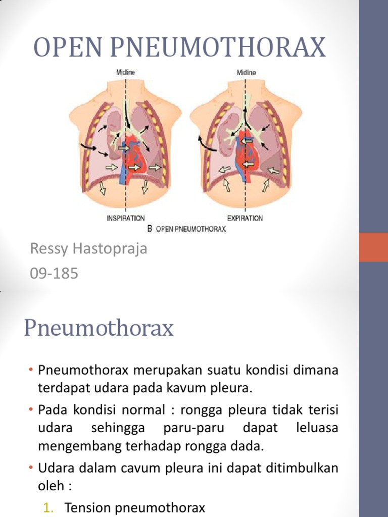 MENGATASI OPEN PNEUMOTHORAX | PDF