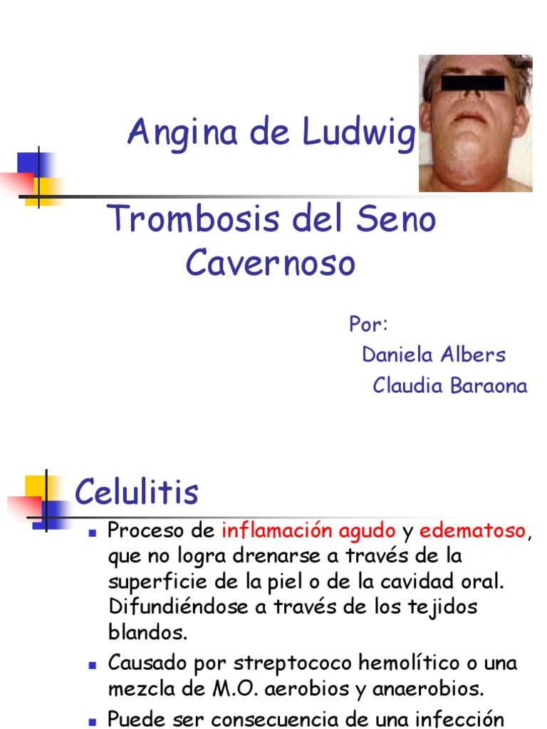 Angina de Ludwig | PDF