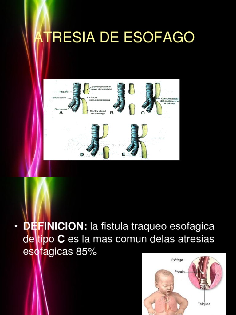 Atresia de Esofago | PDF